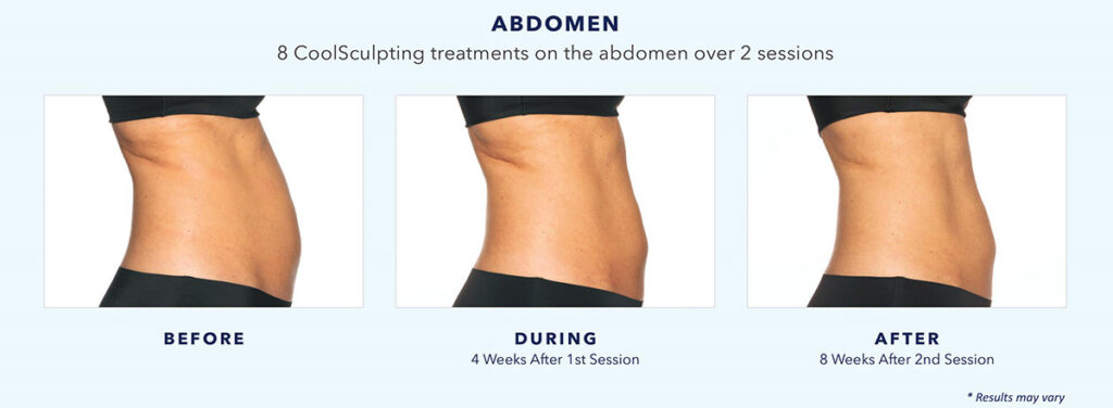 CoolSculpting Dallas | Non-Surgical Fat Removal | FDA Cleared, Effective