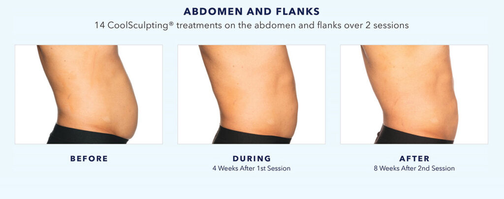 CoolSculpting Addison | FDA Cleared, Effective, Non-Surgical Fat Removal